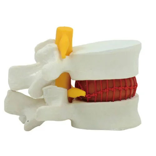 Lumbar Disc Herniation Demonstration Model for Medical Science