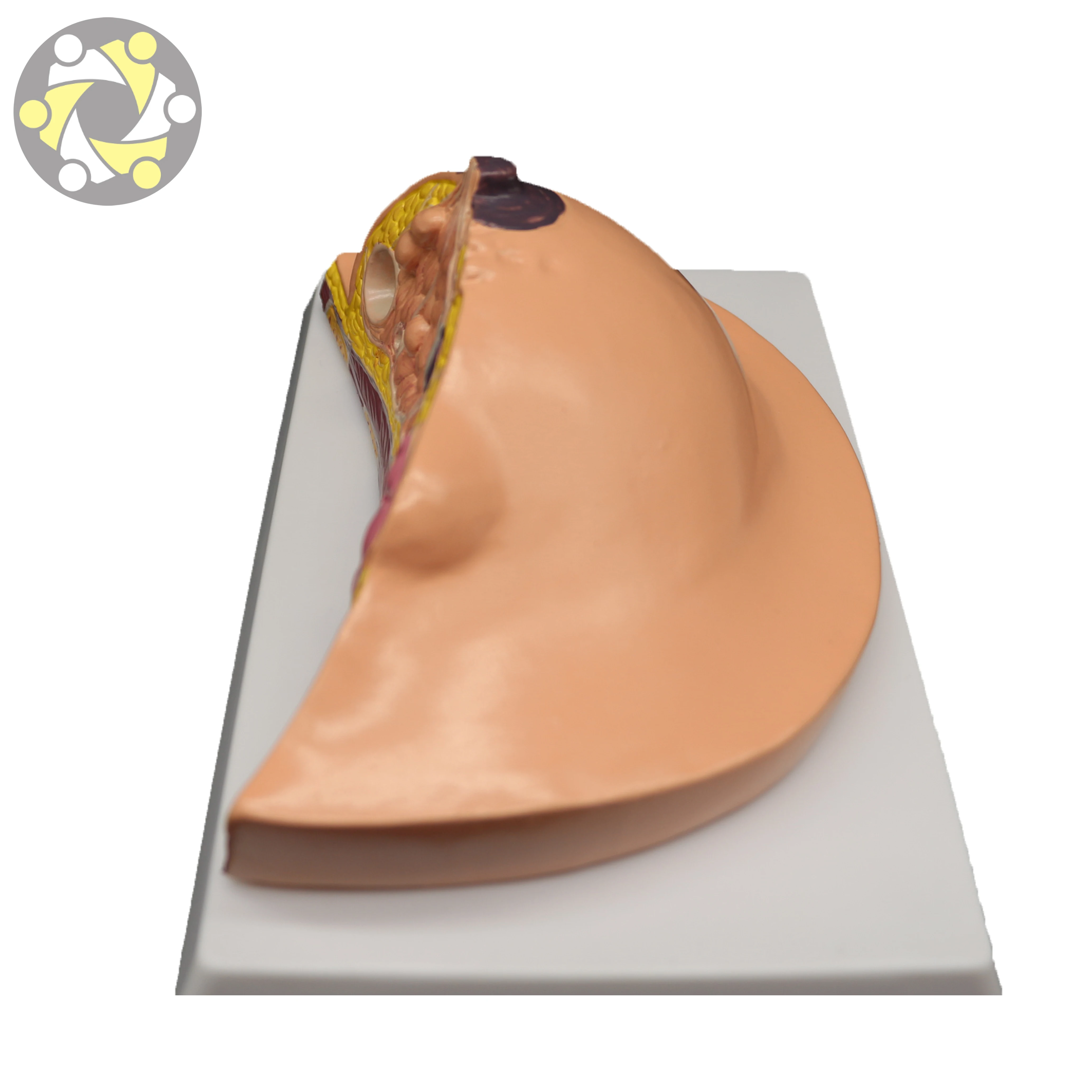 Anatomical Model of Female Breast Cancer - Pathological Medicine