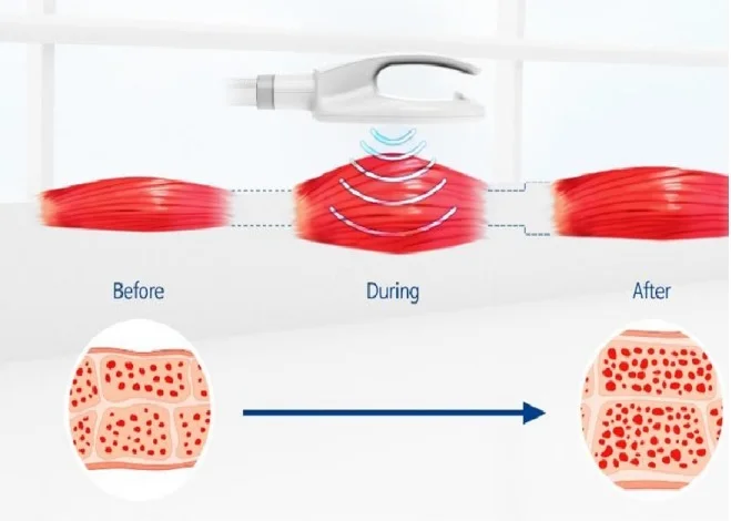 2020 New Magnetic Muscle Stimulator Electrostimulation Muscle ...