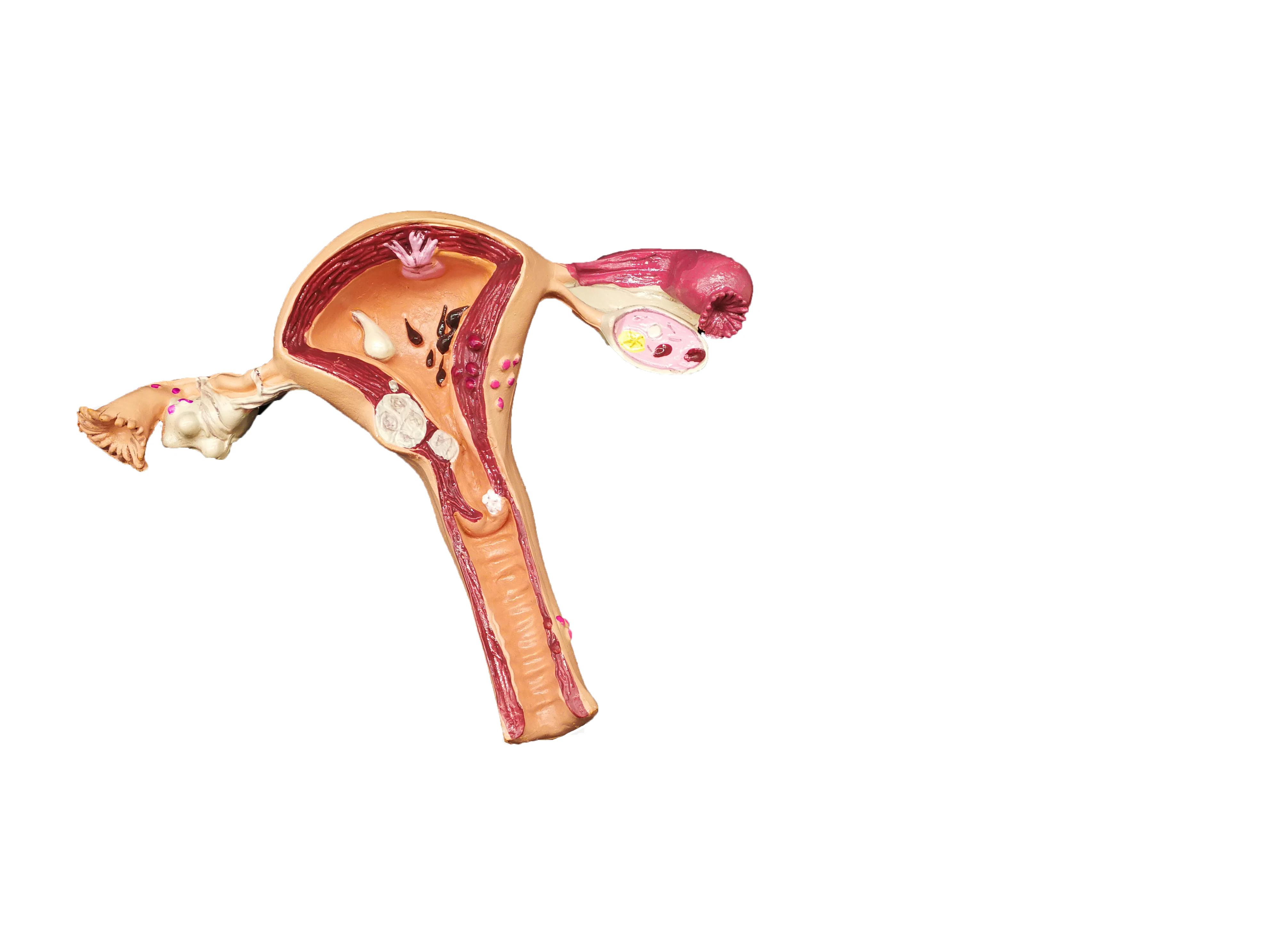 Pathological Anatomical Model Of Female Uterine Fibroids Anatomical ...