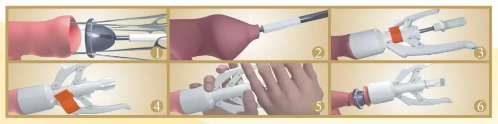 Disposable Forskin Circumcision Stapler Phimosis Treatment Circumcision