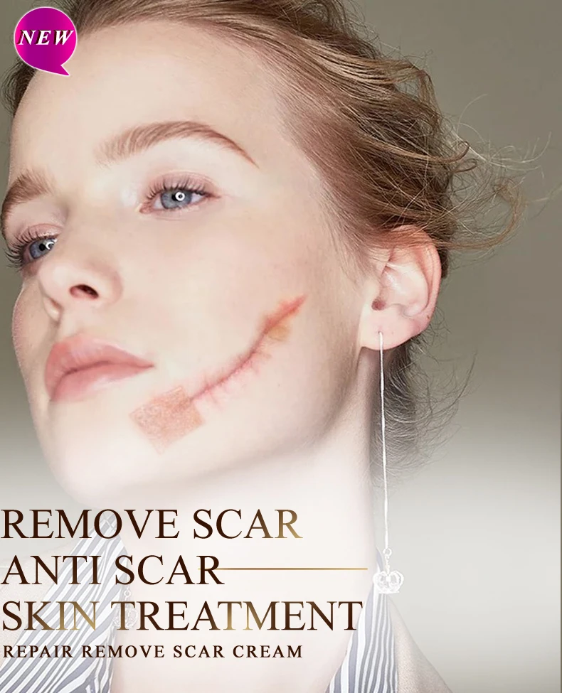 Rtopr Brand Remove Scar Anti Scar Skin Treatment Repair Remove Scar ...