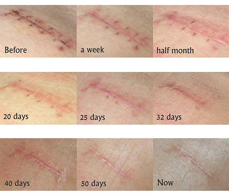 Scar Removal Cream Clinically Proven Scar Treatment Reduces The ...