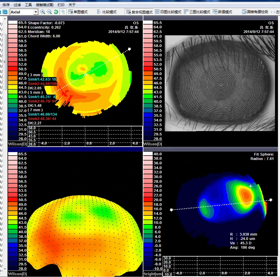 SW-6000 Corneal Topographer - Portable Ophthalmic Equipment