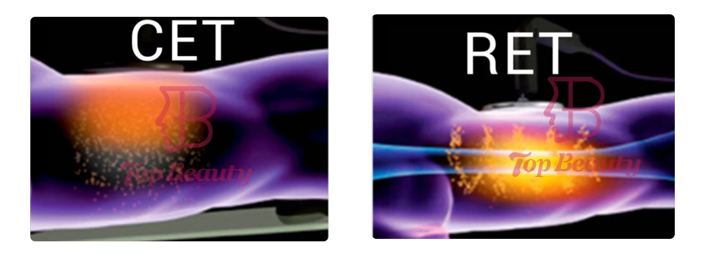 Tekar Therapy Tecar Chiropractic Physio Spine Pain Massage Machine ...