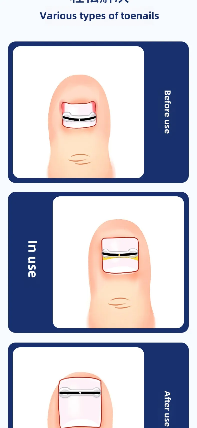 Ingrown Nail Bionic Bone Patch Titanium Alloy Inlaid Nail Steel Wire ...