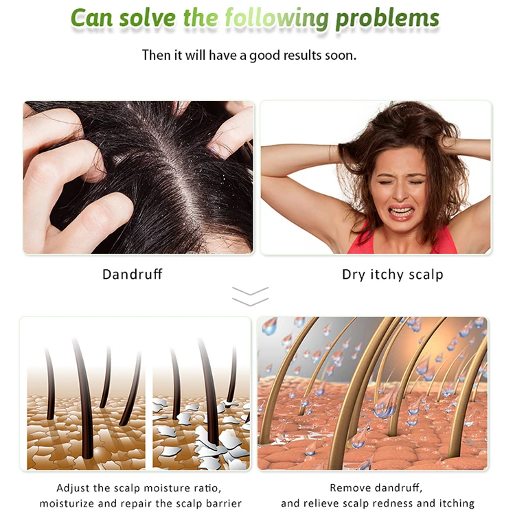 200ml Scalp Refreshing Anti-itch Spray Adjust The Scalp Moisture Ratio ...