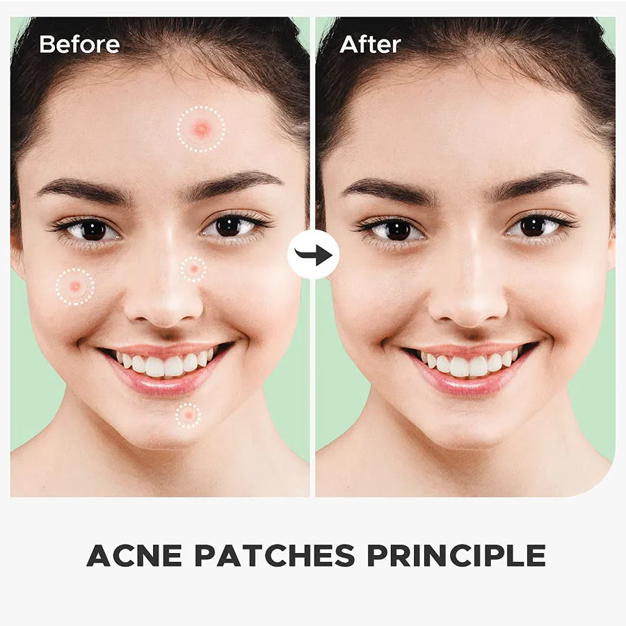 Customized Packing Tea Tree Oil Invisible Waterproof Hydrocolloid Spot ...