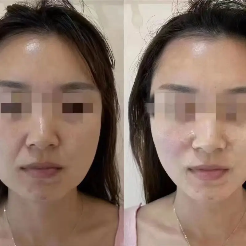 Hifu 2024 New Model Focused Ultrasound Professional Face Lifting ...