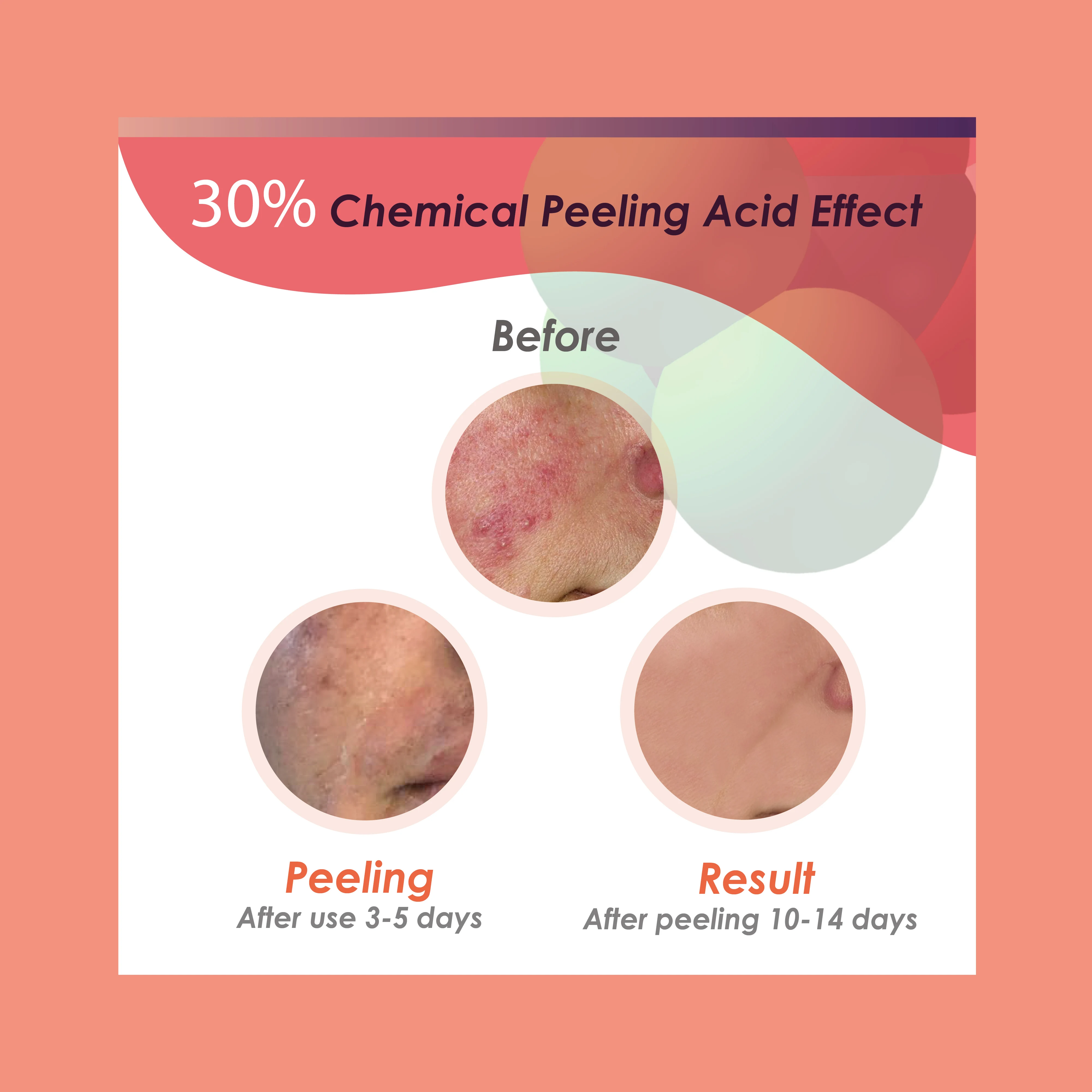 Oem Scar Stretch Mark Removal Professional 30% Chemical Peeling Solution - Buy Tca 30% Acne Scar ...