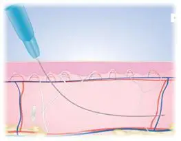 Pdo Thread: N-cog - Buy Multiple Bidirectional Barbed Pdo Thread,Simple ...