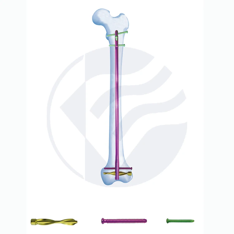 Distal Femoral Interlocking Nail Ii,Femur Interlocking Nail - Buy ...