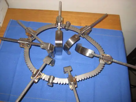 Bookwalter Retractor