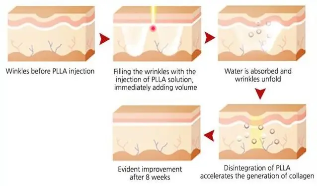 Pdo Pla Plla Pga : Lifting Thread - Buy Face Lifting Thread Pdo,Thread Lift Face Tornado,Gold ...