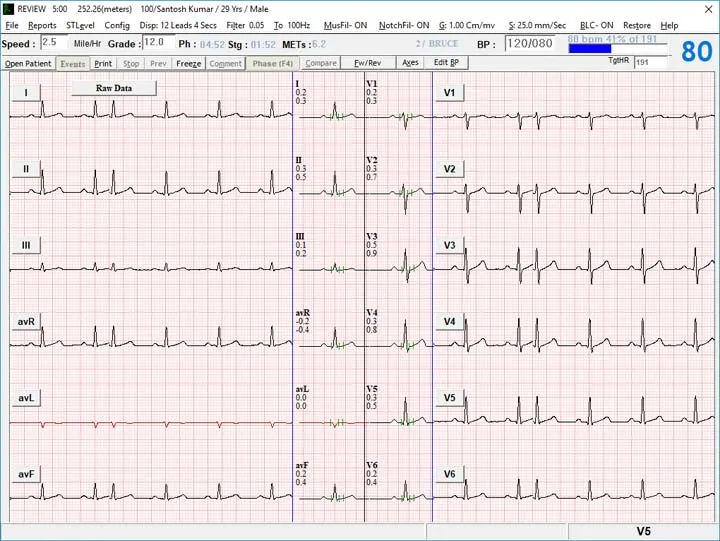 Cardiac Stress Test Ecg And Cardiac Stress Test And Treadmill Test ...